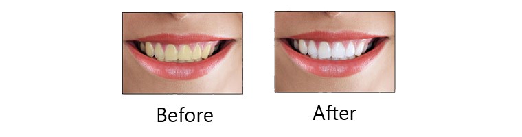 Does Tea Stain Your Teeth? - EKONGSMILE